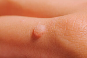 Inclusion Cyst: Causes, Symptoms, Diagnosis, and Treatment - Sri ...